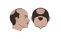 Male Baldness Gene: Does it Come from Your Mother or Father? | Hair ...