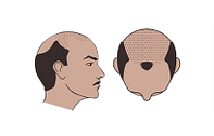 Male Baldness Gene: Does it Come from Your Mother or Father? | Hair ...