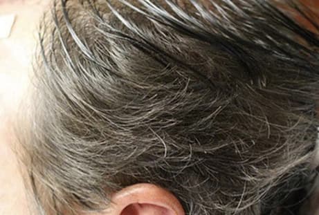 RESTORE® No-Shave FUE Hair Transplant | Keep Your Hair