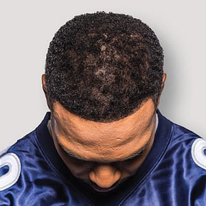 Hair Restoration Results | RESTORE