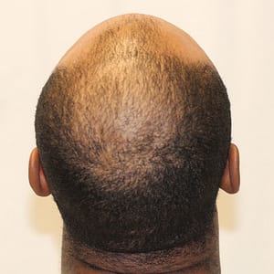 Hair Restoration Results | RESTORE