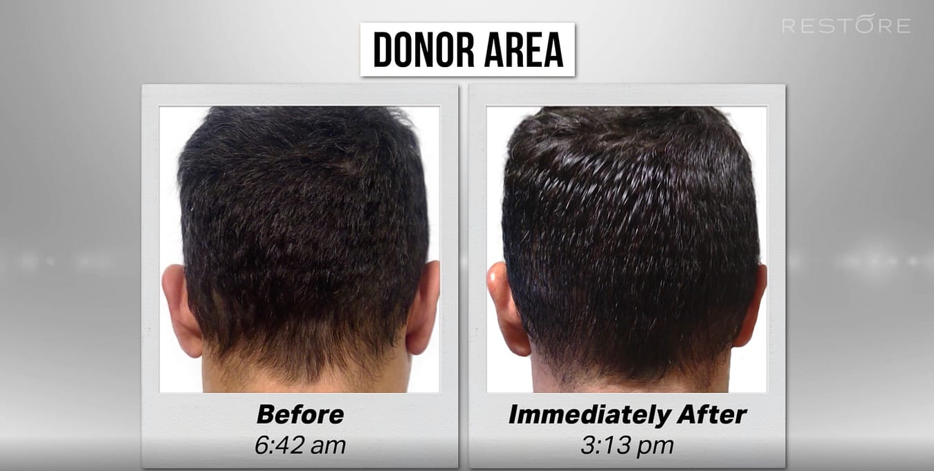 RESTORE® Hair Transplants + Hair Restoration (National)